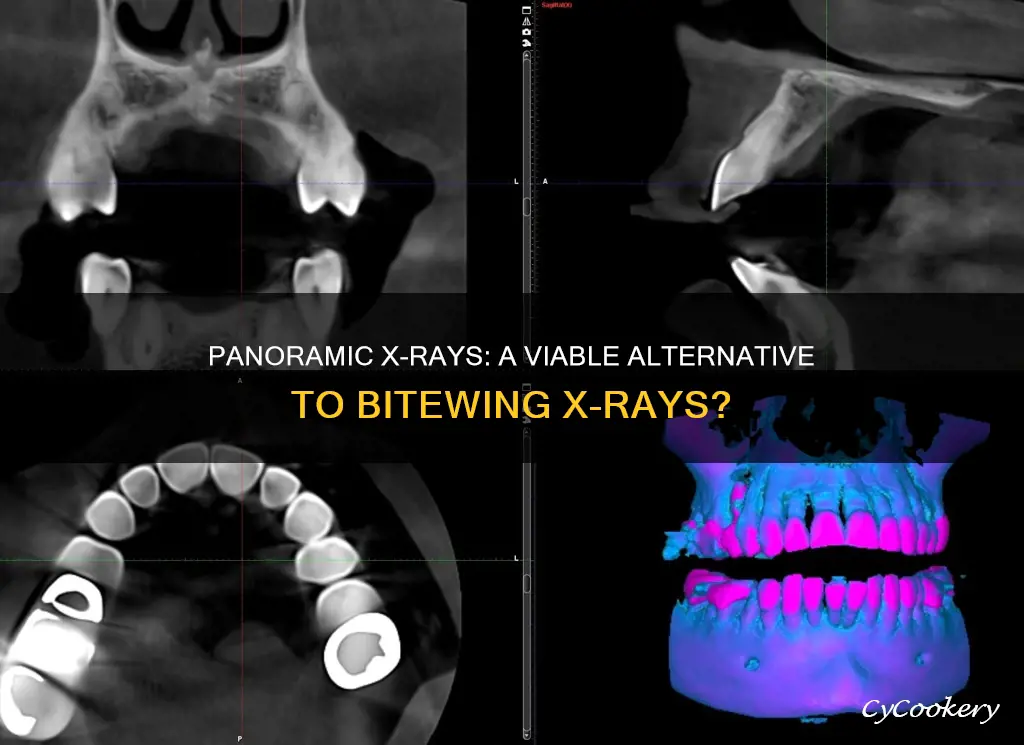 Panoramic X-Rays: A Viable Alternative To Bitewing X-Rays? | CyCookery